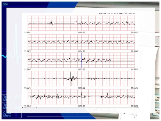 Lethal Cardiac Rhythms - Manual Defibrillation