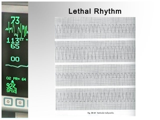 Lethal Cardiac Rhythms - Manual Defibrillation