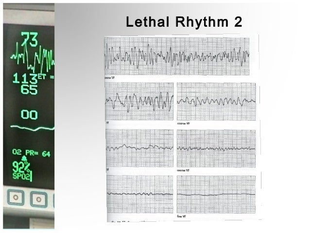 Lethal Heart Rhythms