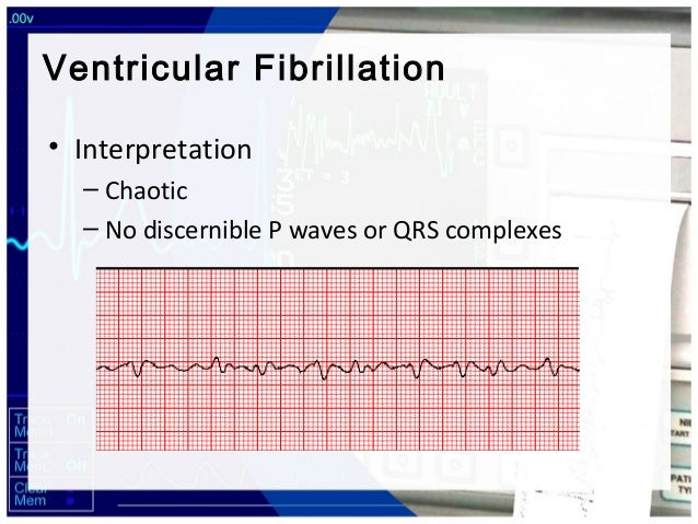 Lethal Cardiac Rhythms - Manual Defibrillation