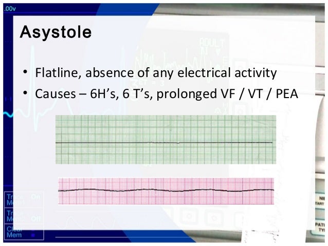 Lethal Cardiac Rhythms - Manual Defibrillation
