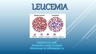 Leucemia | PPTX