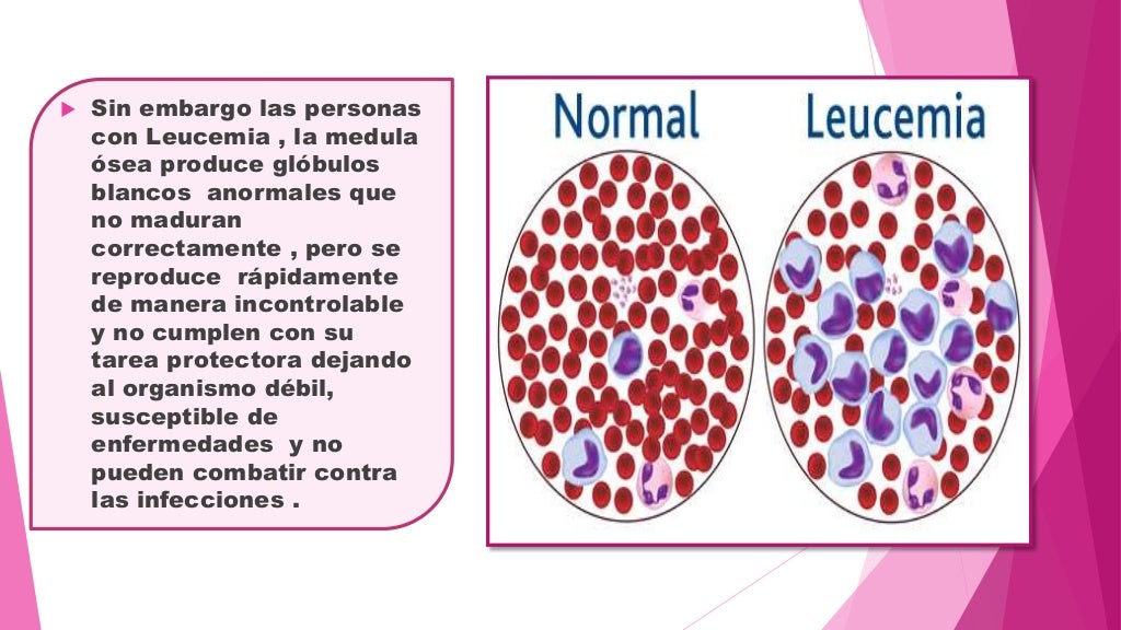 Leucemia: definicion, sintomas, fisiopatologia, diagnostico medico, d…