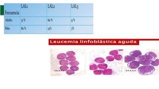 Leucemia | PPTX