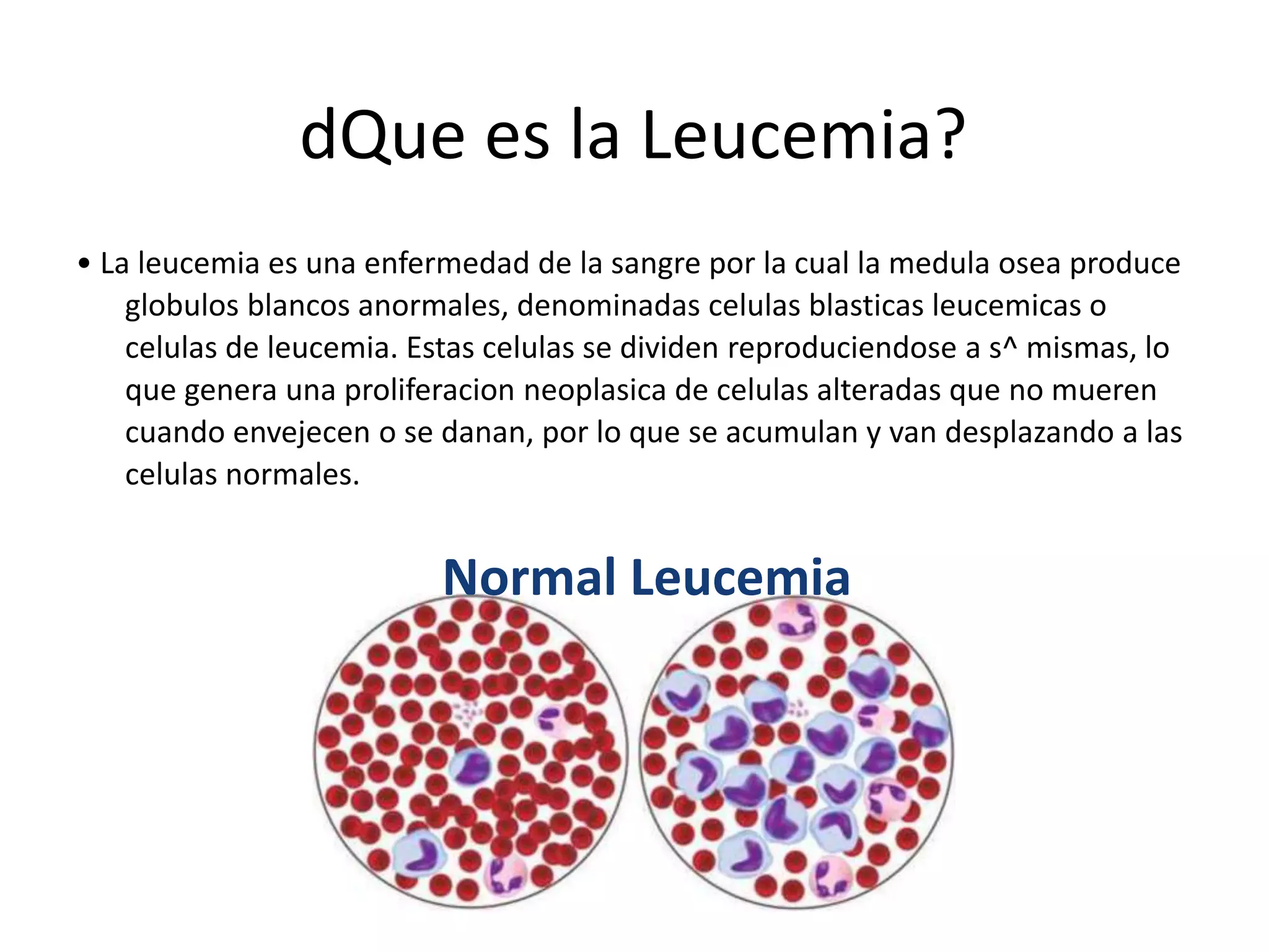 leucemia.ppt