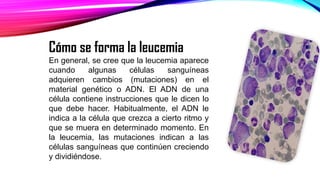 LEUCEMIA..............................pptx