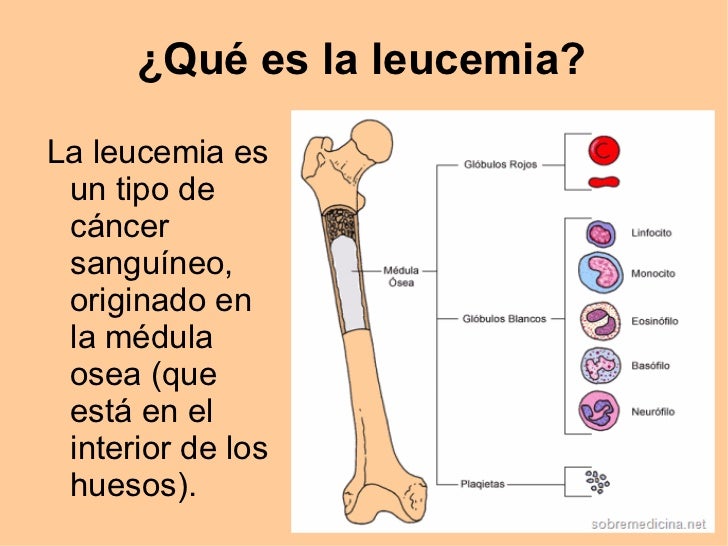 Leucemia cmc Leucemia cmc