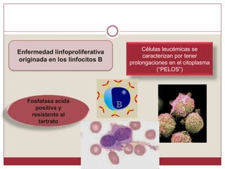 Leucemia De Celulas Peludas | PPTX