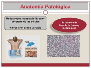 Leucemia De Celulas Peludas | PPTX