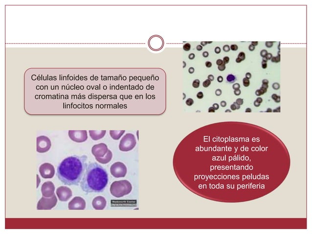 Leucemia De Celulas Peludas | PPTX