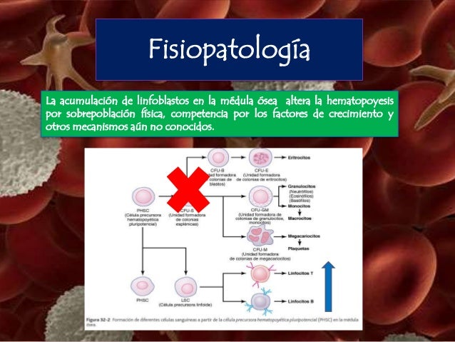 Leucemia Linfoblástica Aguda