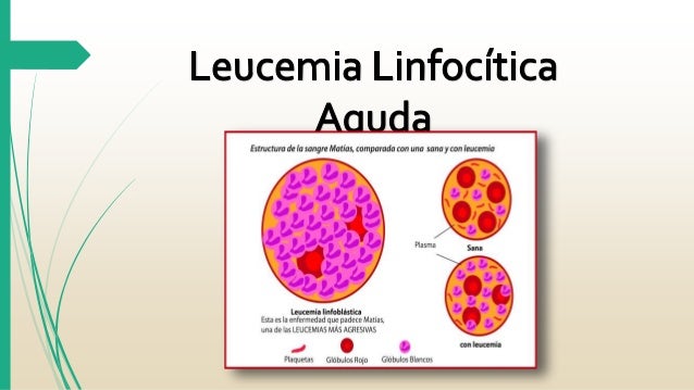 Leucemia linfoblástica aguda
