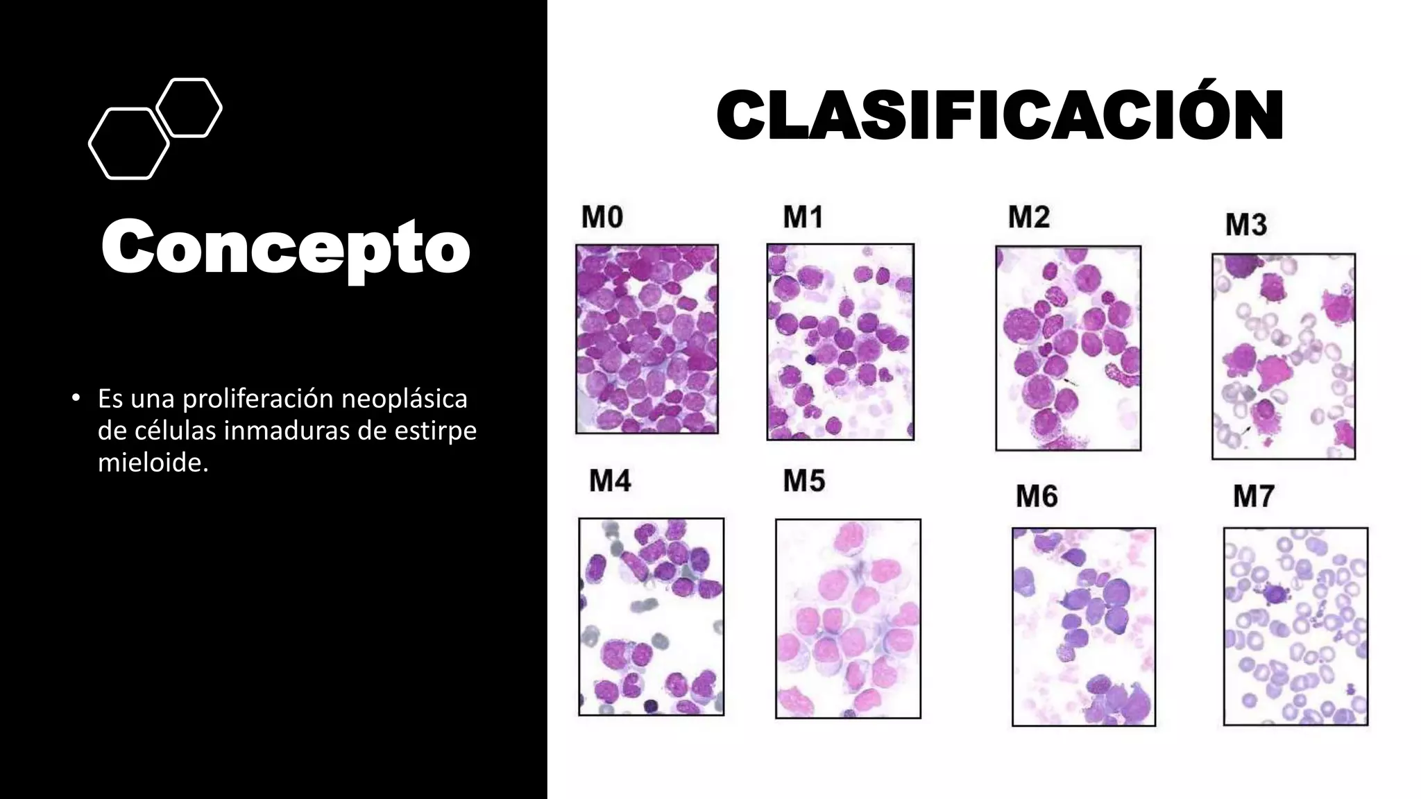 LEUCEMIA MIELOIDE AGUDA.pptx