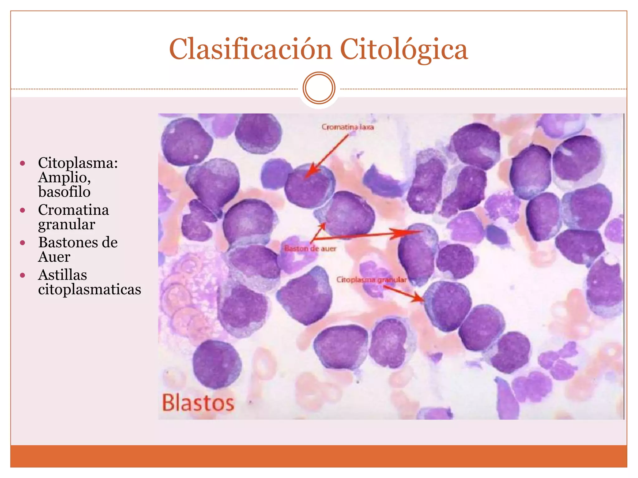 Leucemia mieloide aguda (lma) | PPTX