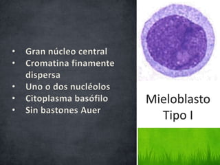 Leucemias agudas | PPTX