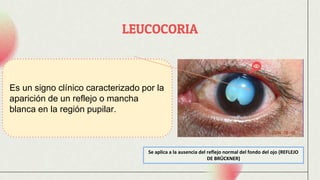 LEUCOCORIA PPT.pptx