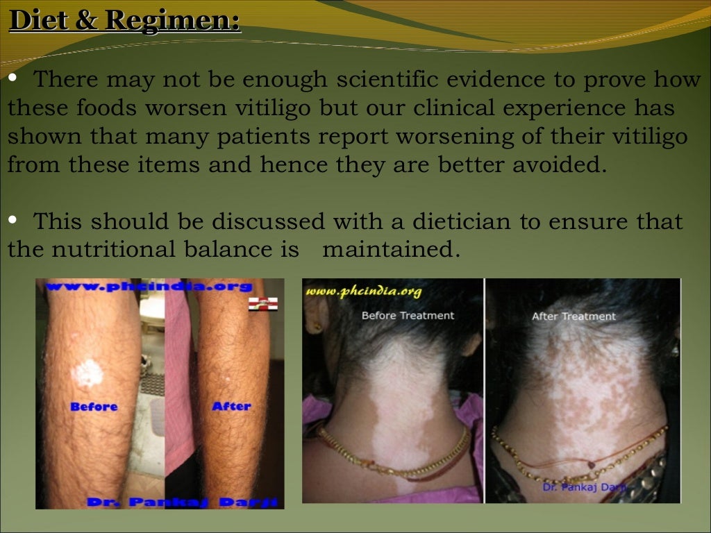 Leucoderma presentation