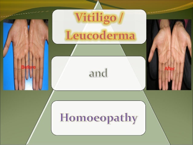 Leucoderma presentation