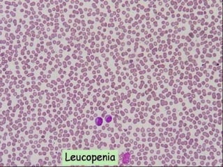 LEUCOPENIA.pptx
