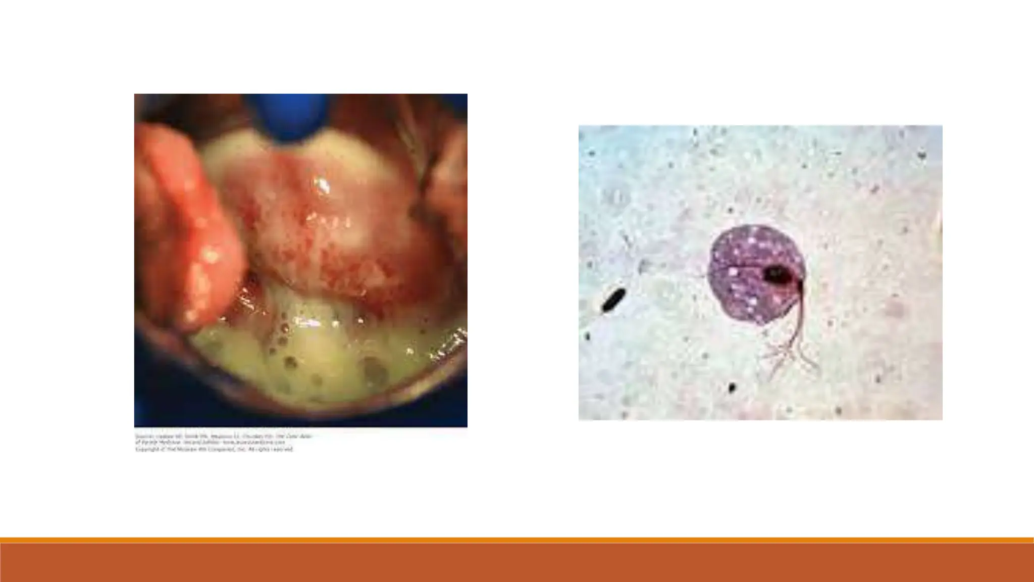 LEUCORRHEA VAGINITIS obstetrics Gyna.pptx