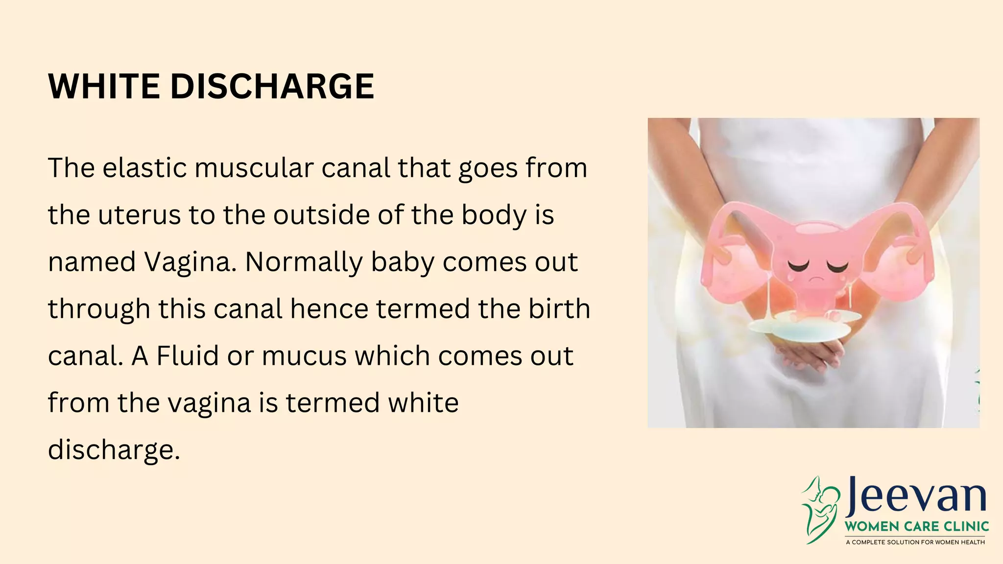 LEUCORRHEA (WHITE DISCHARGE)1 (1).pdf