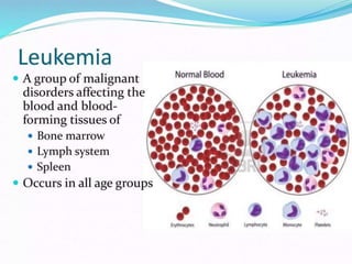 leukaemia.pptx blood disorders bleeding wbc | PPT