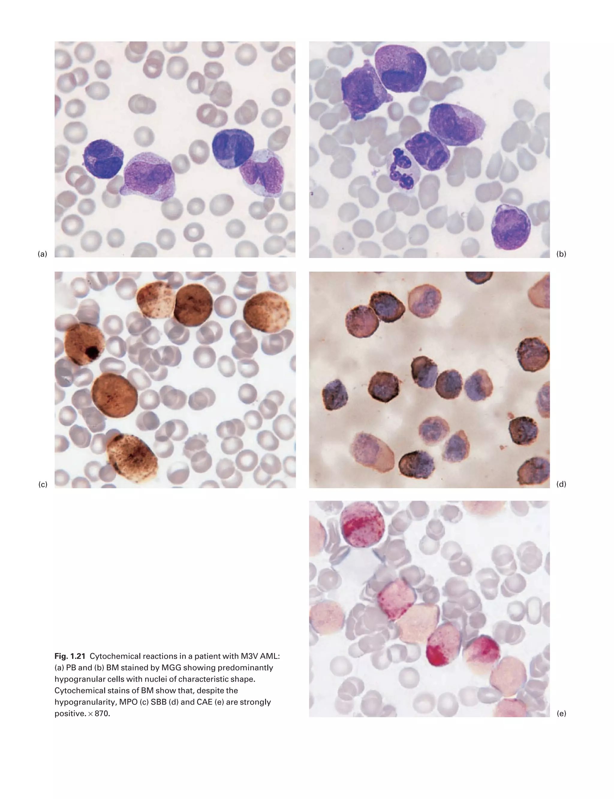 Leukaemia Diagnosis ( PDFDrive ).pdf