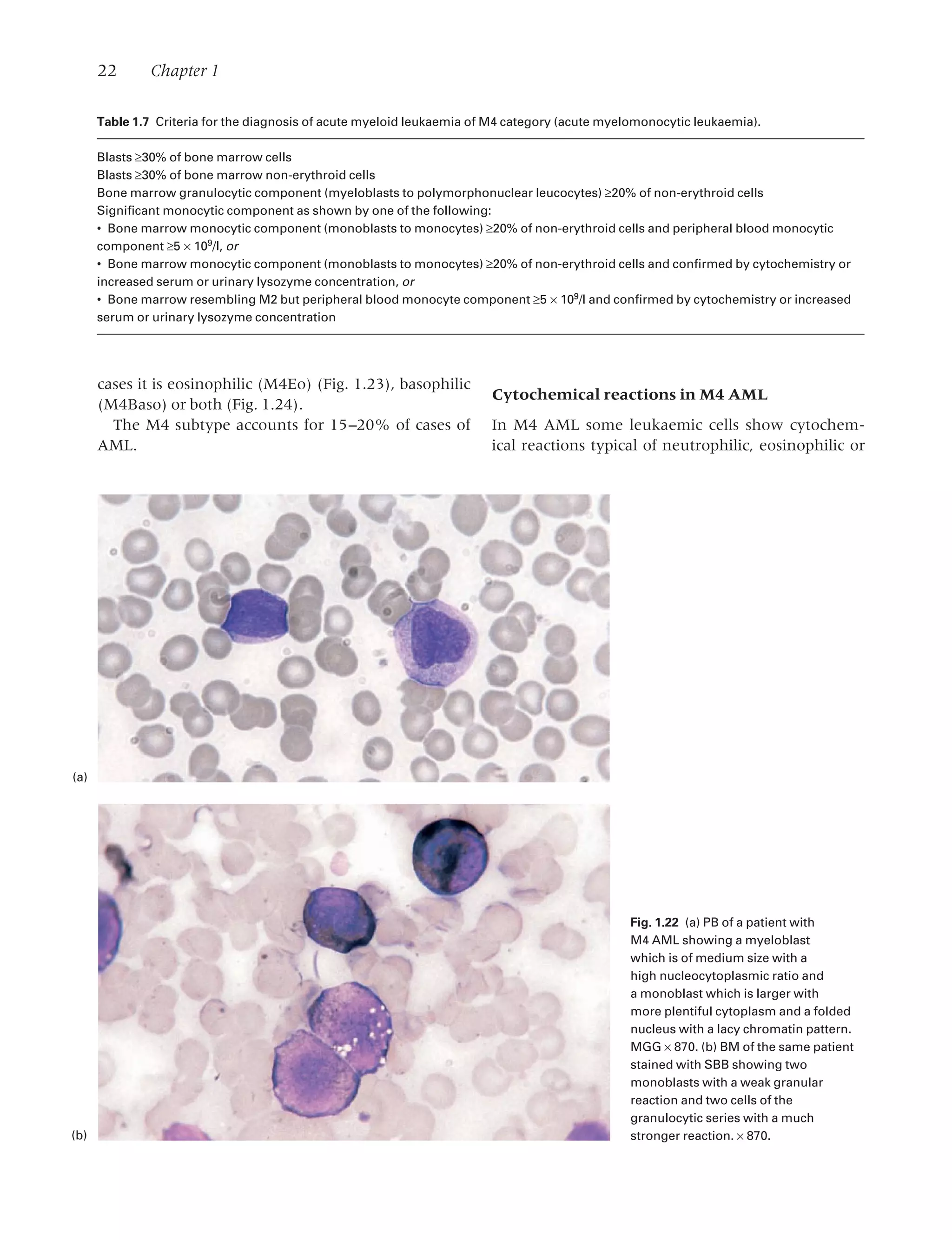 Leukaemia Diagnosis ( PDFDrive ).pdf