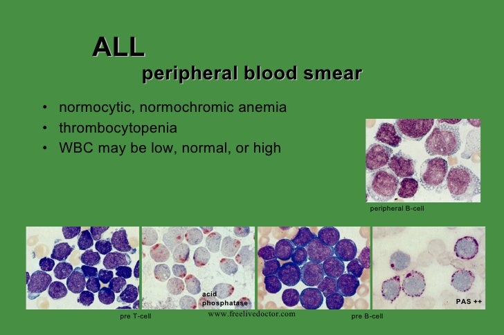 Leukemia