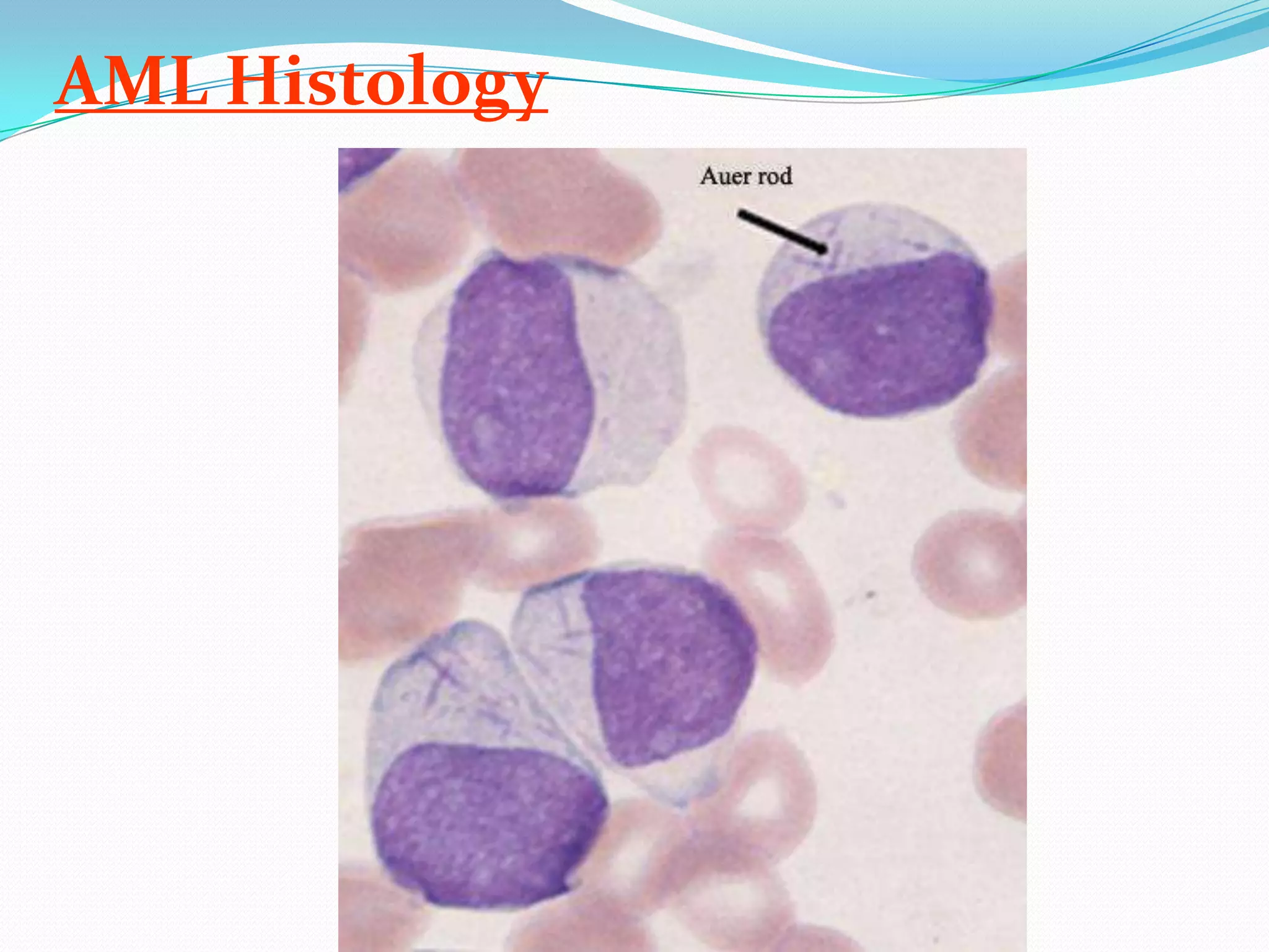 leukemia | PDF