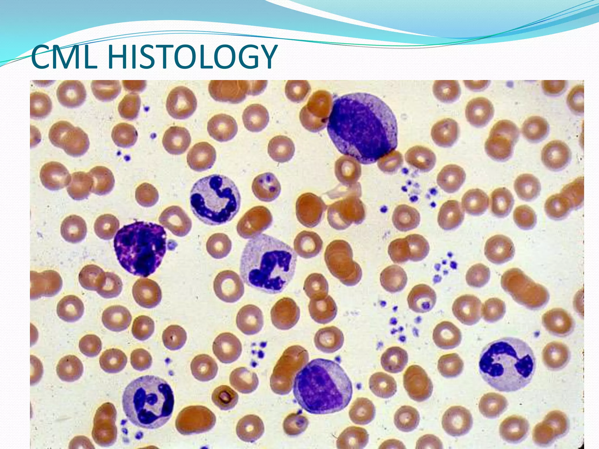 Leukemia | PPTX