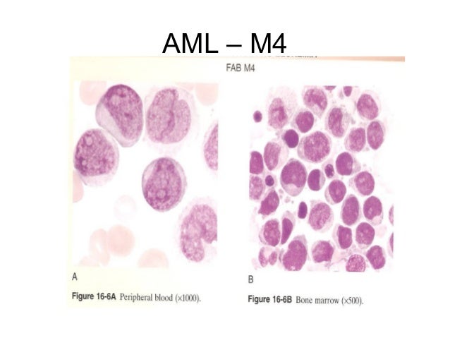Leukemia