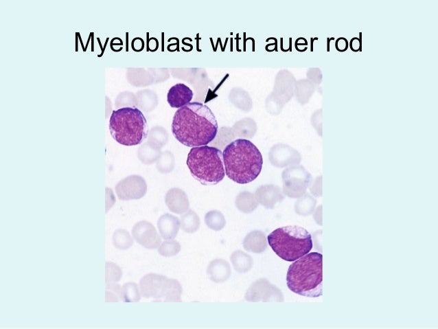 Leukemia