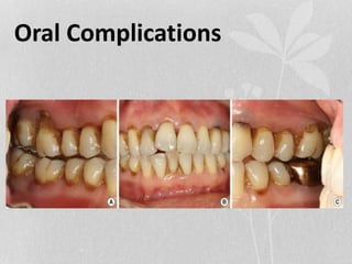 Leukemia and oral manifestations | PPTX