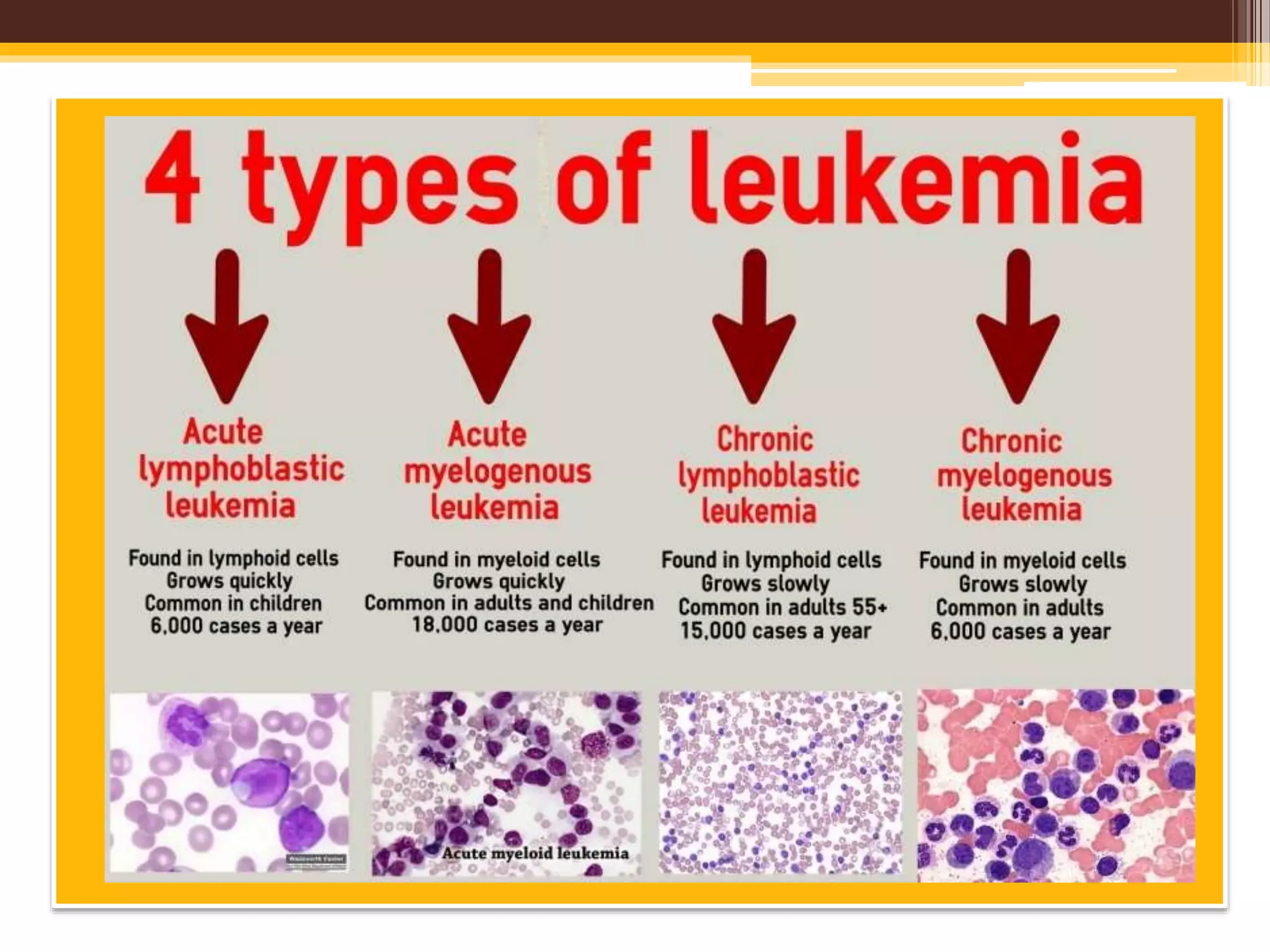 Leukemia | PPTX
