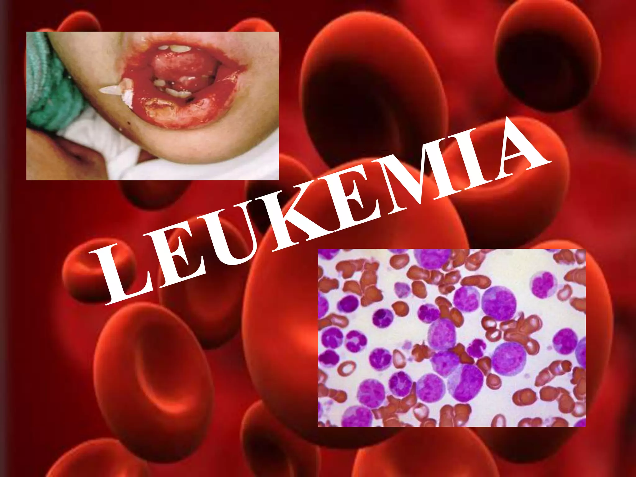 Austin Leukemia | PPT