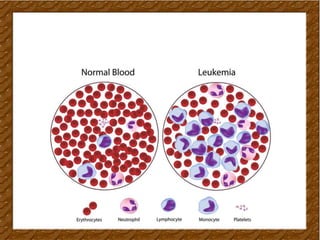 Austin Leukemia | PPT