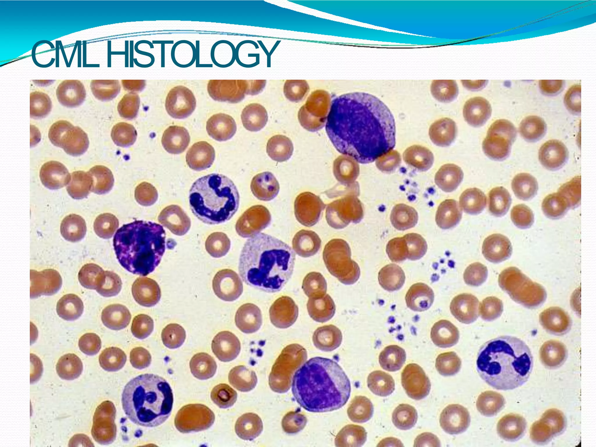 Leukemia | PPTX