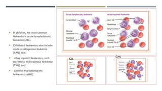 Leukemia in children | PDF