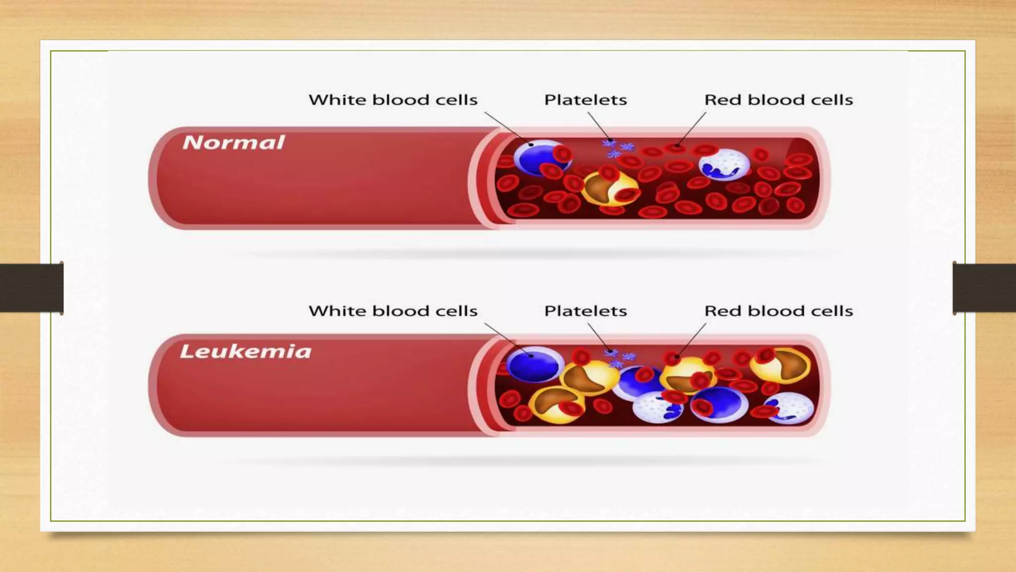Leukemia (blood cancer) presentation | PPTX
