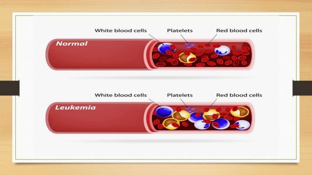 Leukemia (blood cancer) presentation | PPTX | Blood Disorders ...