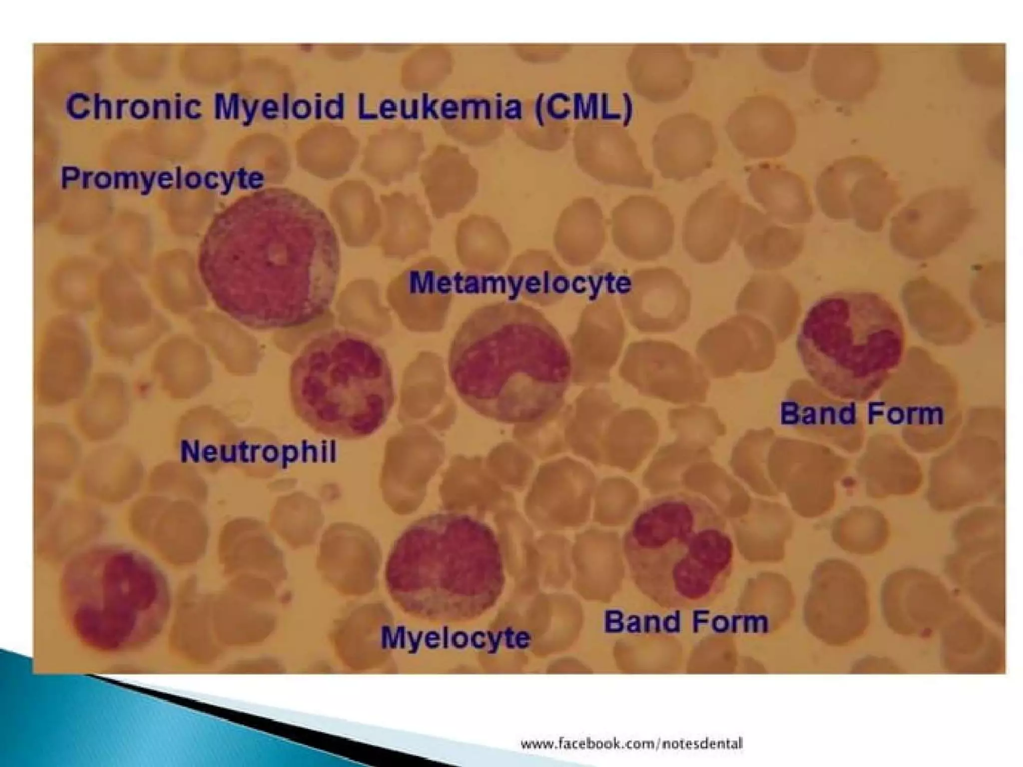 leukemia.pptx