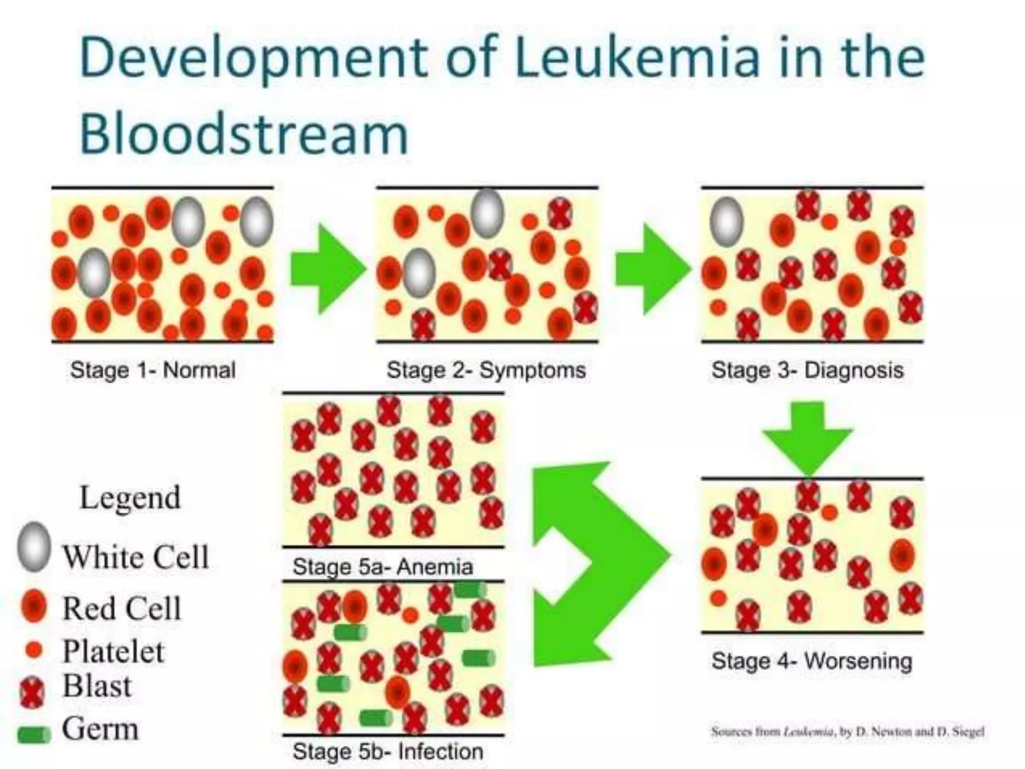 leukemia.pptx