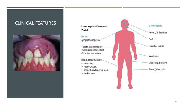 LEUKEMIA.pptx | Blood Disorders | Diseases and Conditions