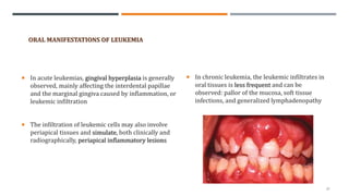 LEUKEMIA.pptx