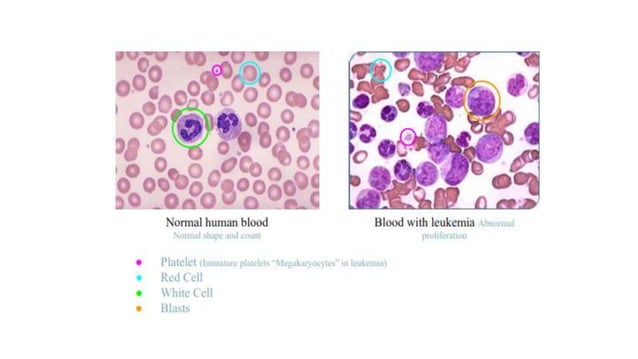 LEUKEMIALeukemia, historic perspective, etiology, risk factors ...
