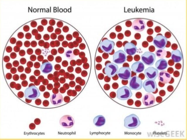 Nursing management of a patient with leukemia | PPTX