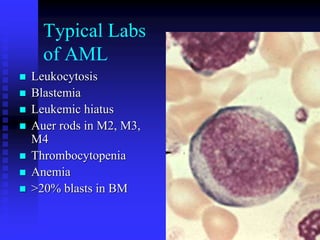Leukemia (1).ppt and bio marker and cbc | PPT