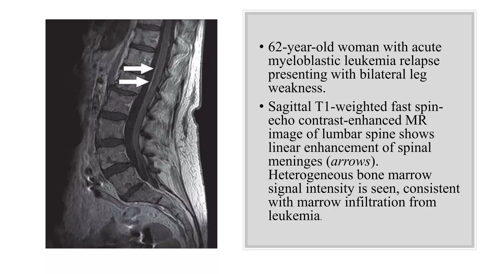 Leukemias and Neurological menifestations | PPTX