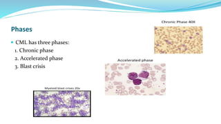 Leukemia and its types presentation 1 | PPTX